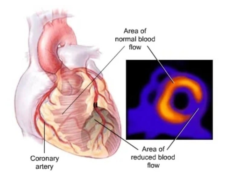Preparing for a Nuclear PET Stress Test