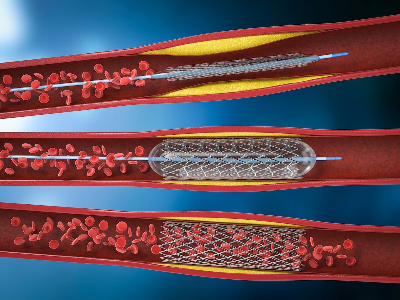 Peripheral Angioplasty, Atherectomy, and Stenting | Heart & Vascular Care
